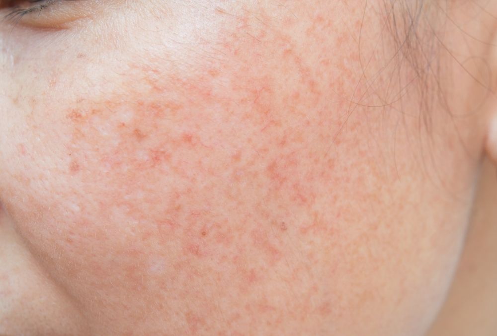 Systemic Lupus Erythematosus (Butterfly Disease) | Dr. Saliha Demir